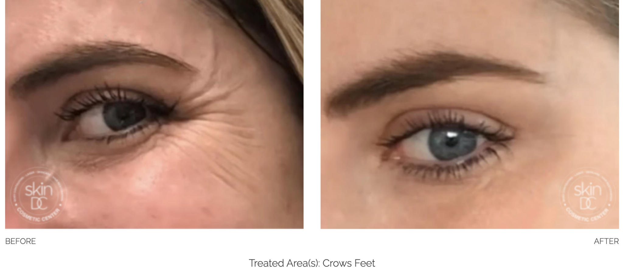 Botox Gallery | SkinDC | Botox in Arlington VA