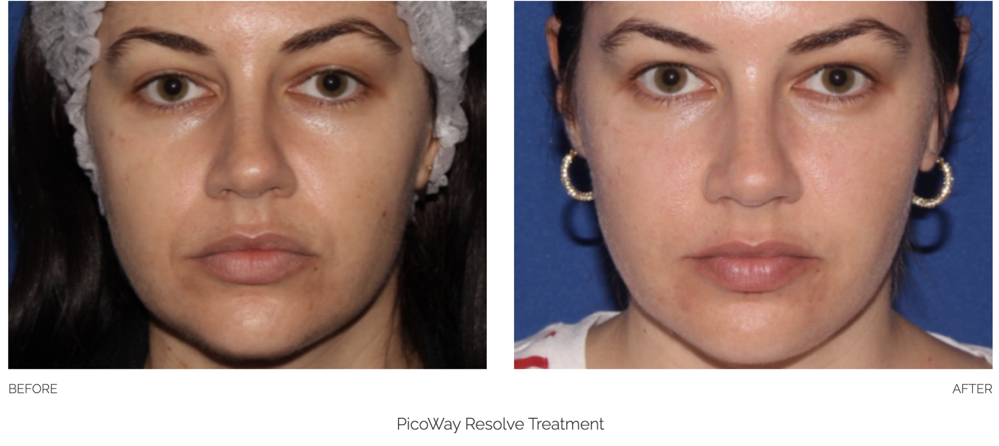 PicoWay Resolve Resurfacing Gallery | SkinDC | Arlington Skin Rejuvenation