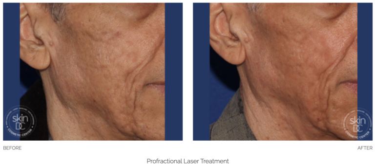 Profractional Laser Resurfacing Gallery | SkinDC | Arlington Dermatology