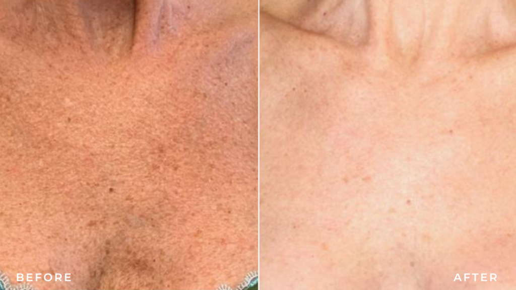 BBL HEROic | SkinDC | Arlington VA BBL HEROic