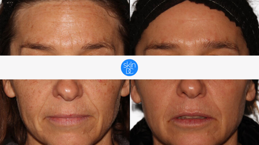 BBL BroadBand Light Gallery | SkinDC | Arlington Skin Treatment