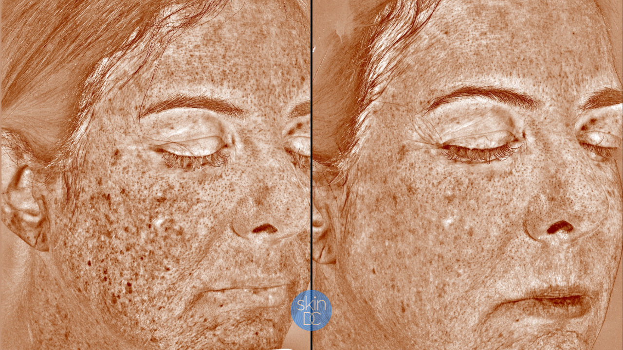 Vbeam Vascular Laser Gallery | SkinDC | Laser Procedures in Arlington