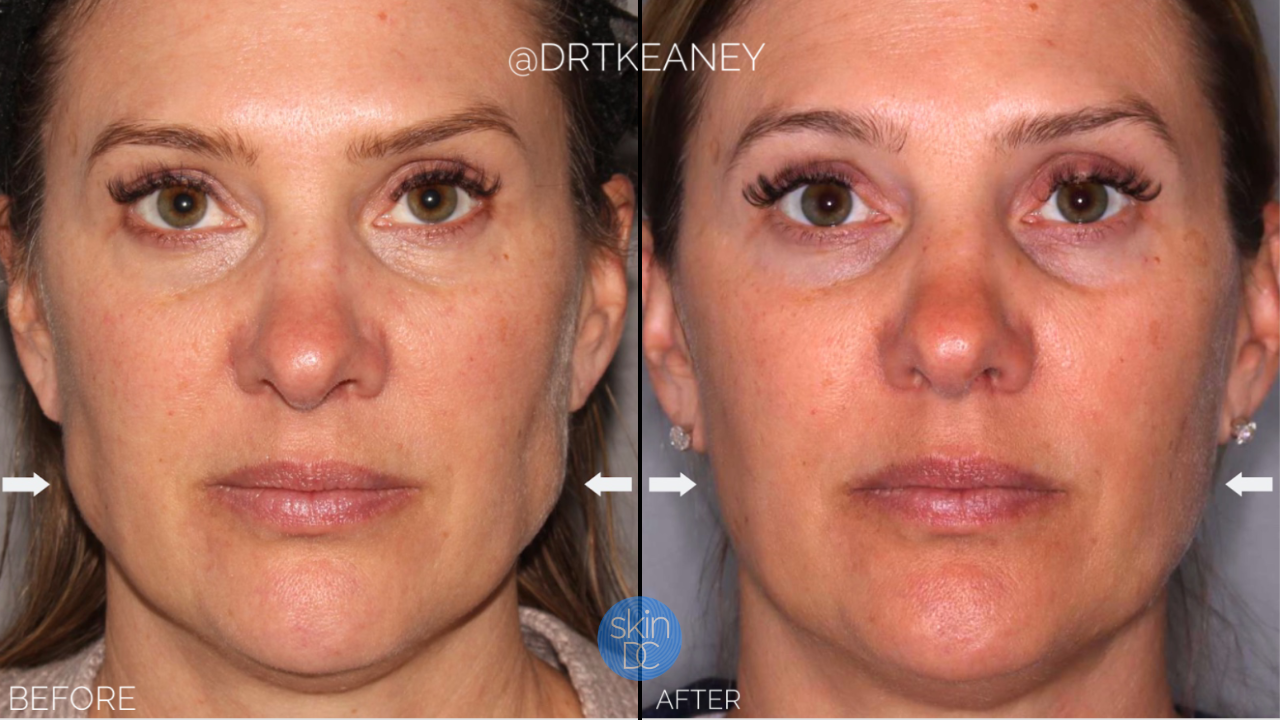 Botox Gallery | SkinDC | Botox in Arlington VA