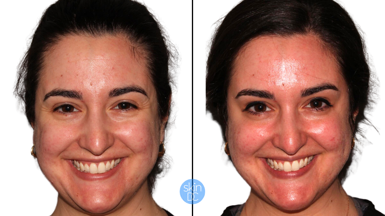 Botox Gallery | SkinDC | Botox in Arlington VA