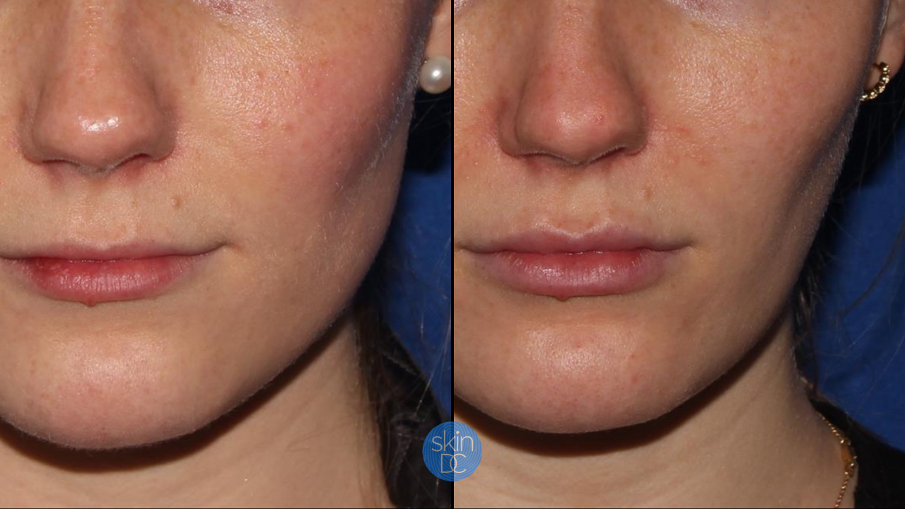 Botox Gallery | SkinDC | Botox in Arlington VA