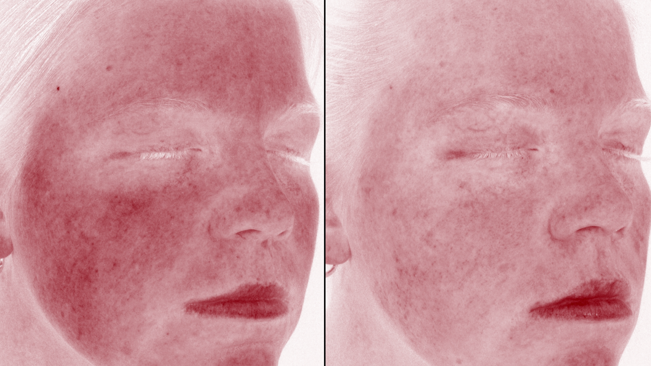 Vbeam Vascular Laser Gallery | SkinDC | Laser Procedures in Arlington