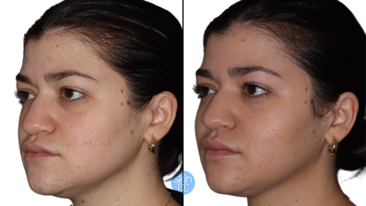 Dermal Fillers Gallery | SkinDC | Dermatology in Arlington