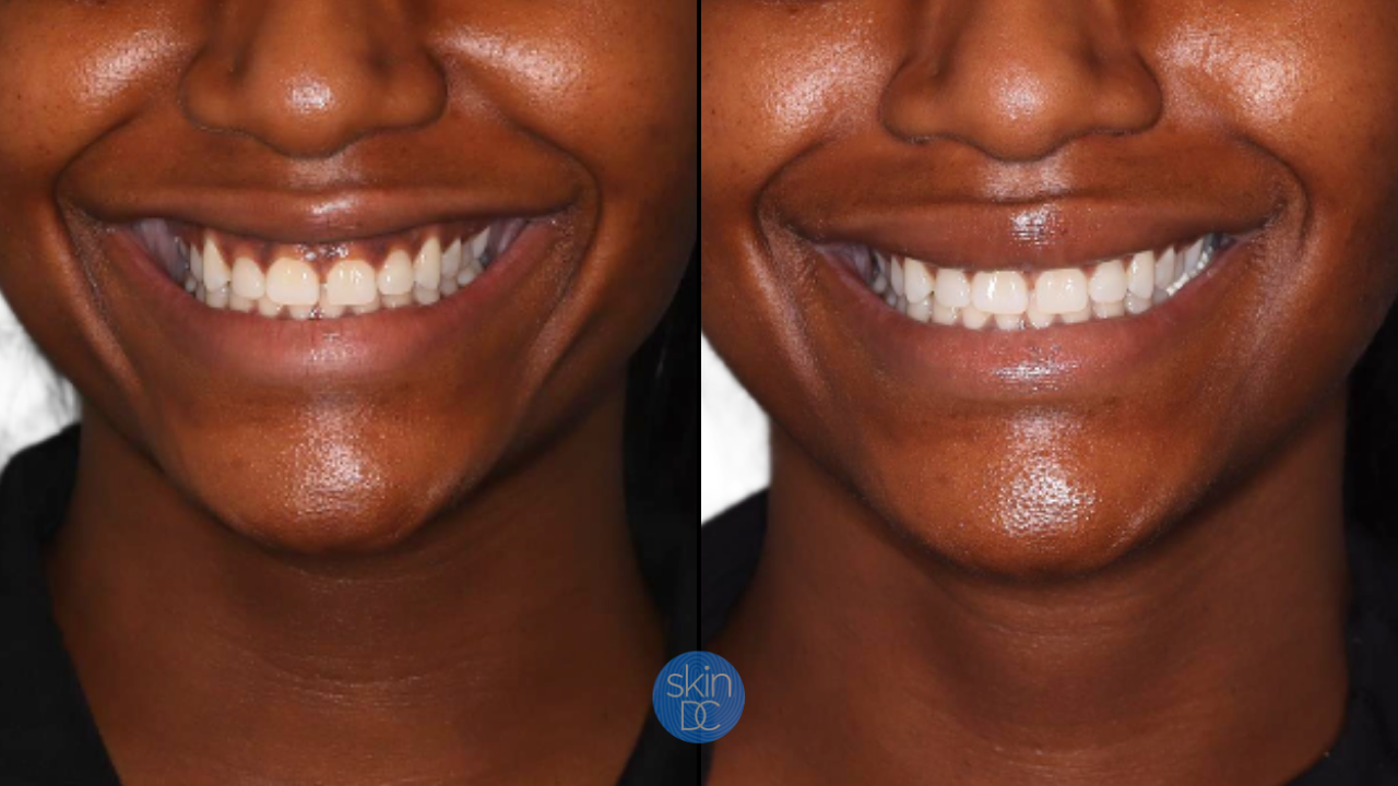 Botox Gallery | SkinDC | Botox in Arlington VA