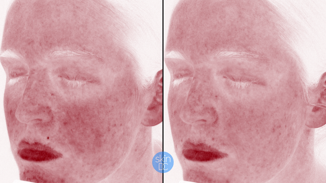 Vbeam Vascular Laser Gallery | SkinDC | Laser Procedures in Arlington